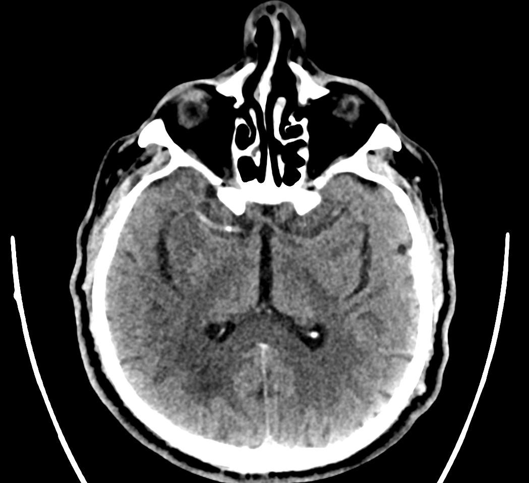 Case of the Week 22 2018 - Radiology Case Cafe
